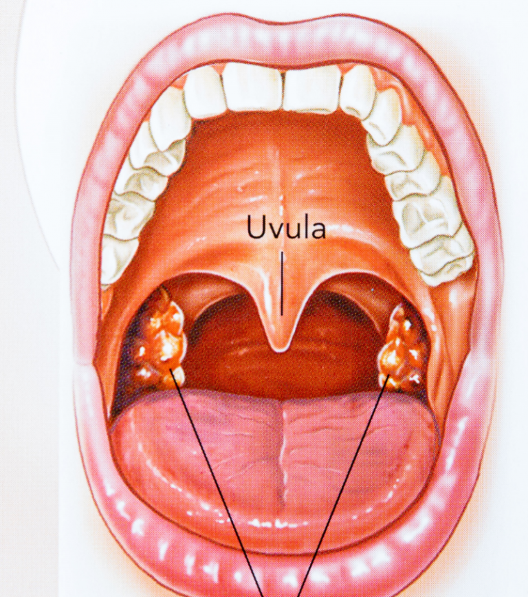 Recurrent Tonsillitis Specialist Sydney | Dr Crawford Recurrent Tonsillitis Specialist Sydney | Dr Crawford